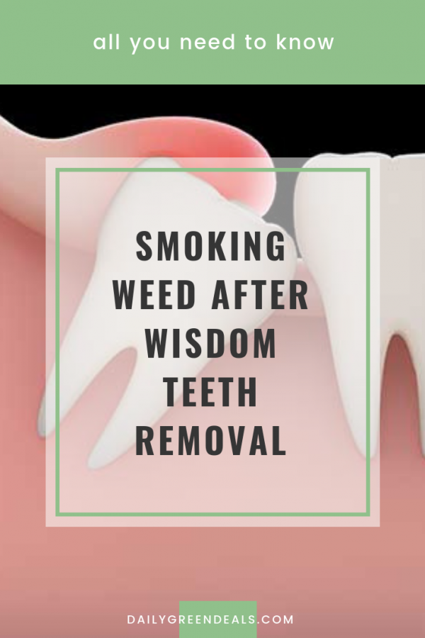 Smoking Weed After Wisdom Teeth Removal January 2023 - Daily Green Deals